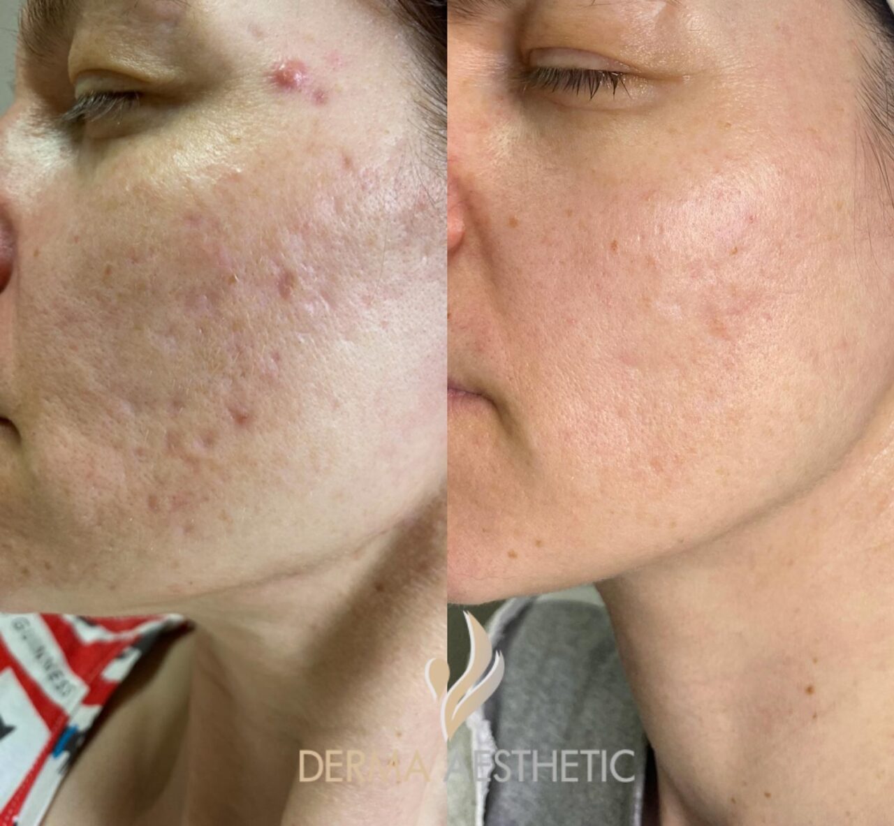 Micro Needling - Derma Aesthetic